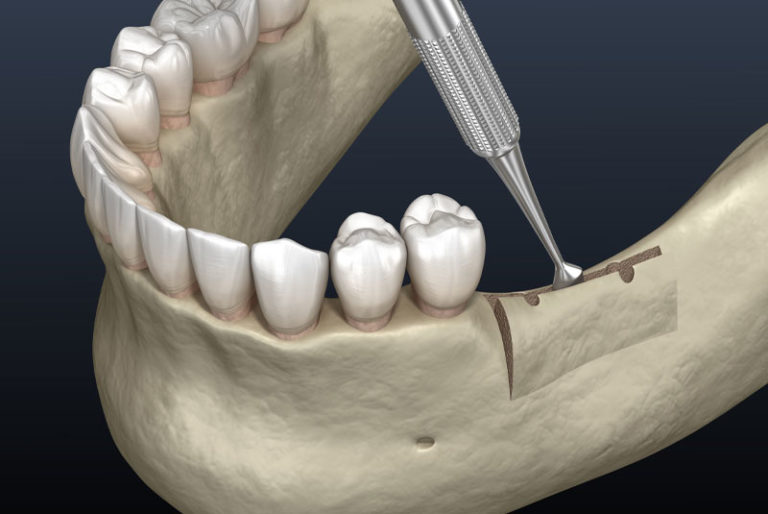 Ridge Augmentation - Leesburg, VA - Dr. Fadi Hasan