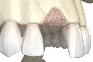 Ridge Preservation - Sterling, VA - Dr. Kharmouche